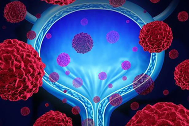 Unravelling the complexities of bladder cancer - Cell & Chemical Biology